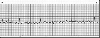 What is Fibrillation ? - NURSING DIAGNOSIS